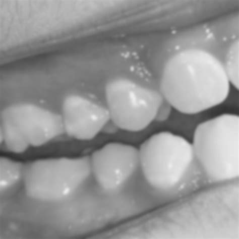 Uneven Pressure Distribution Tooth Damage In Ankylosed Teeth