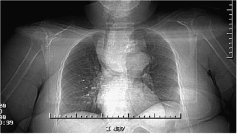 American Thyroid Association Statement On Optimal Surgical Management