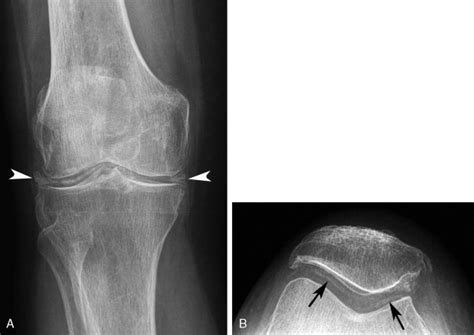 Calcium Pyrophosphate Dihydrate Crystal Deposition Disease Clinical Tree