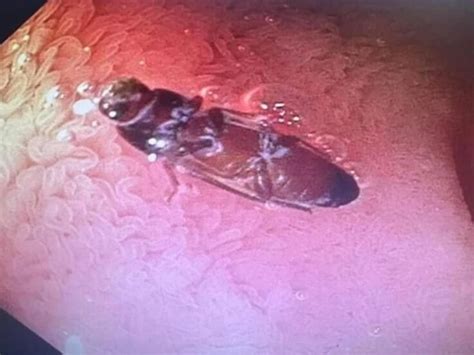 مرد ۲۳ ساله با درد شکم، سوسک ۳ سانتی‌متری را در روده‌اش حمل می‌کرد عکس