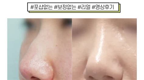 매부리코 코수술로 완전 탈출한 사례 부산 서면 코성형 코재수술유명한곳 네이버 Tv