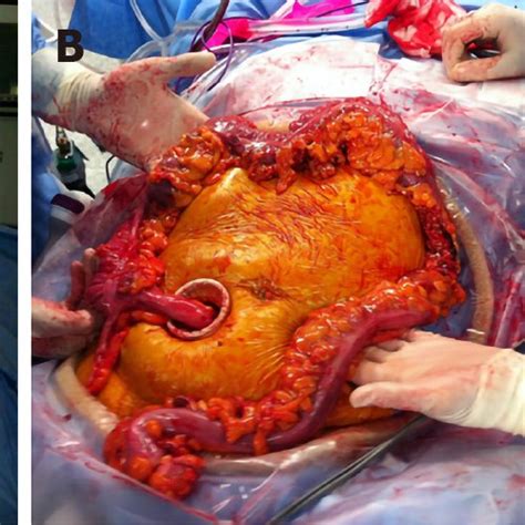 The End Ileostomy Was Then Matured At The Single Port Access Site Download Scientific Diagram