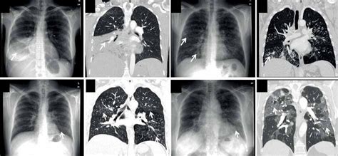 A Chest Radiograph Cxr Of A Patient With Streptococcus Pneumonia Download Scientific Diagram