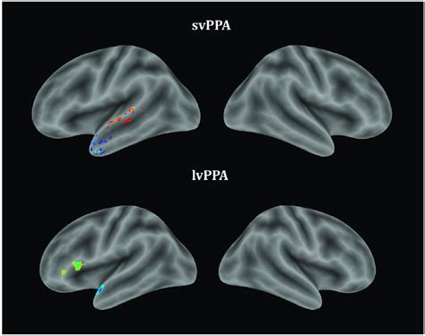 Gray Matter Regions Associated With Object And Action Naming Download Scientific Diagram