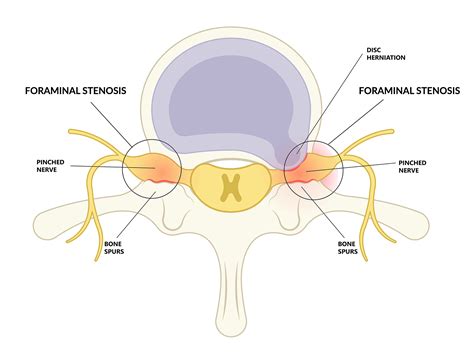 Bilateral Foraminal Stenosis Bonati Spine Institute