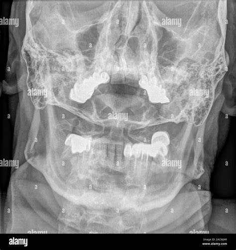 Cervical Spine X Ray With A Fractured Dens A 50 Year Old Male Patient