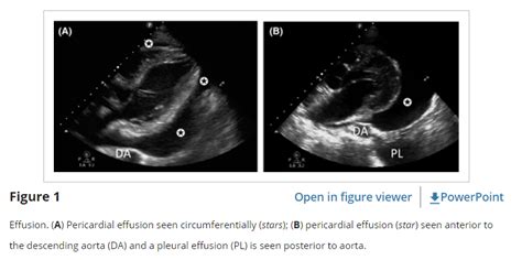 Techniques For Assessing Effusion