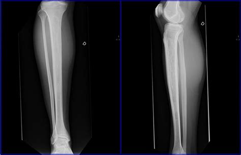 intraossäres Lipom der Tibia pacs
