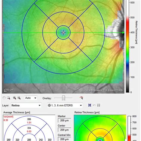 Retinal Thickness Analysis Algorithm In Which Mean Thicknesses In Download Scientific Diagram
