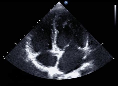 Trans Thoracic Echo Courses Training Semester Emse Egyptian Medical Society Of Echocardiography