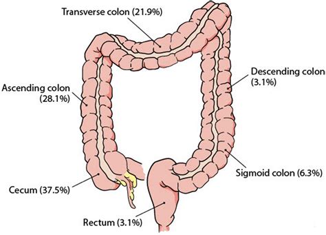 Distribution Of Colonic Polyps Resected Using Combined Endoscopic Download Scientific Diagram