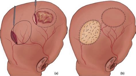 SCALP RECONSTRUCTION Dr Jyoshid