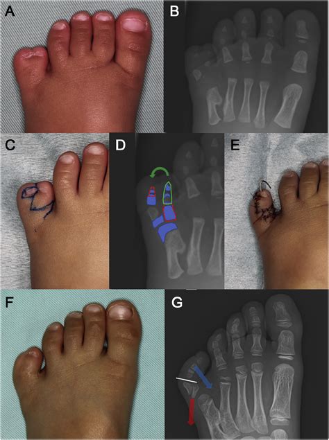 Treatment For Lateral Ray Polydactyly With Brachydactyly Of The Foot