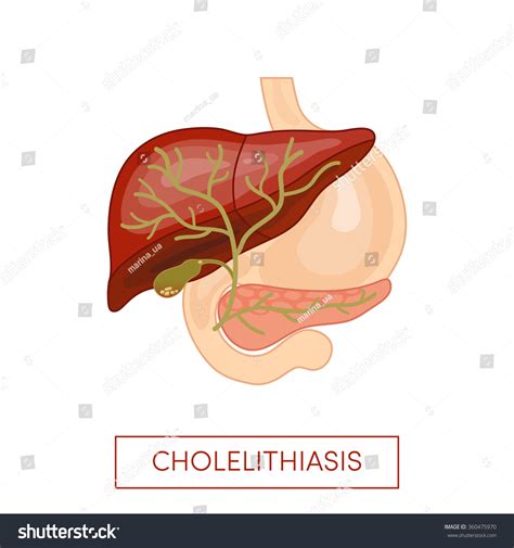 Cholelithiasis Gallstone Disease Gallbladder Duct Human Stock Vector