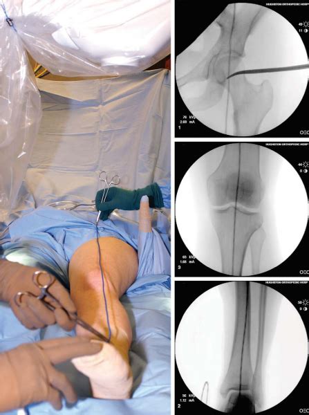 Olecranon Fractures Open Reduction Internal Fixation Teachme Orthopedics