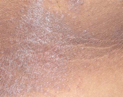 Skin Results Atopic Dermatitis Opzelura® Ruxolitinib