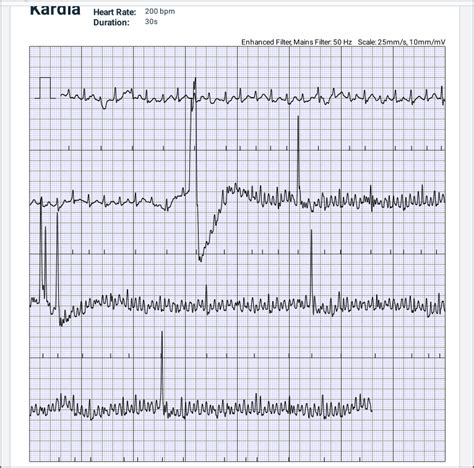 How Do You Know When It S Time To Go To The ER R AFIB