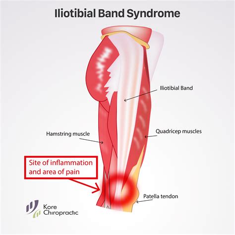 The Iliotibial Band Which Is A Thick Extension Of The Tensor Fascia