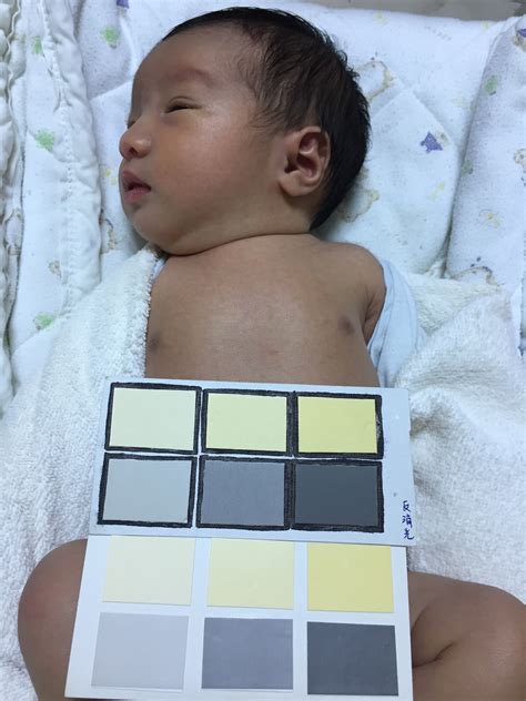 Jaundice Object Detection Dataset By Livercheck