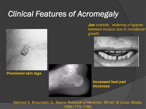 Ppt Diagnostic Approach Of Acromegaly Powerpoint Presentation Free