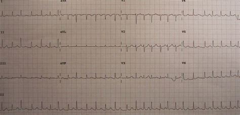 Cardiac Tamponade Cardiovascular Medbullets Step 1