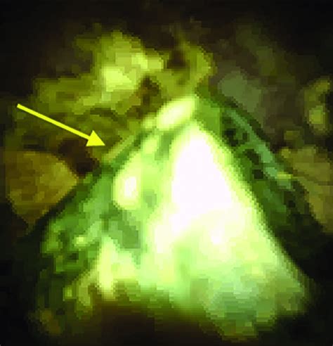 Cholangioscopy Directed Electrohydraulic Lithotripsy Was Again Download Scientific Diagram