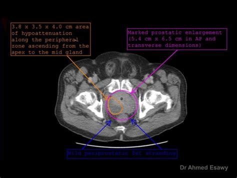 Imaging Prostatitis Urethritis Dr Ahmed Esawy Pdf