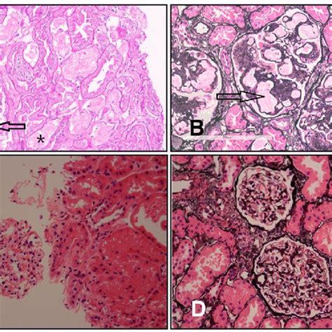 Light Microscopy Of Glomerulus In The Biopsy Specimen Of Lpg Patient