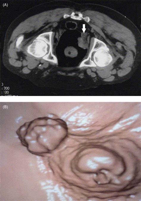 Ct Cystography And Virtual Cystoscopy In The Assessment Of New And Recurrent Bladder Neoplasms