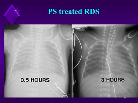 Respiratory Distress Syndrome Rds PPT