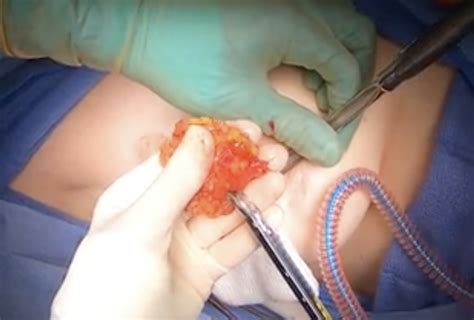 What Happens During A Lumpectomy And Sentinel Node Biopsy