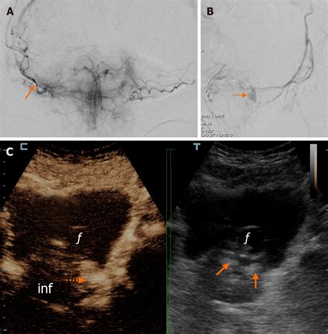Intentionally Unilateral Prostatic Artery Embolization Patient Selection Technique And