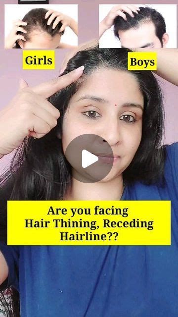 Shalini ♥️ On Instagram 🌟🌟bald Patches Thining Hairline Big Forehead Problems Then Use This