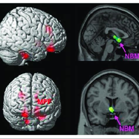 statistical parametric mapping based correlations between 11 c meqaa a7