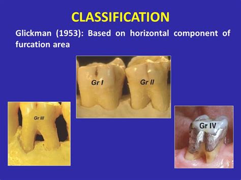 Management Of Furcation Involvement By Various Approaches Ppt Video