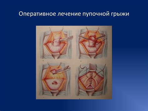 Грыжи у детей - презентация онлайн