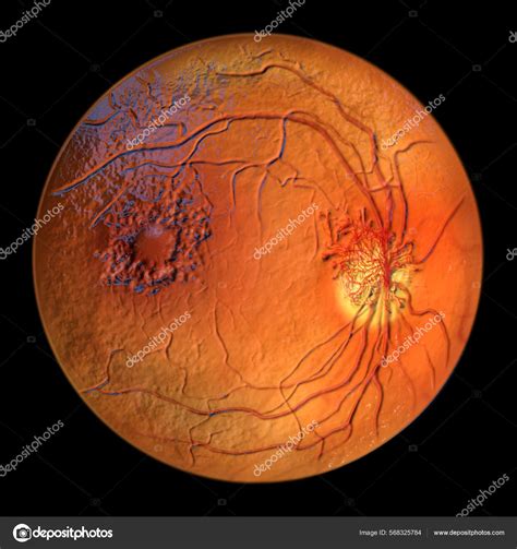 Proliferative Diabetic Retinopathy Illustration Showing Neovascularization Disk Macula Edema