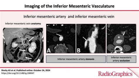 Inferior Mesenteric Artery Ct Chronic Mesenteric Ischaemia Due To