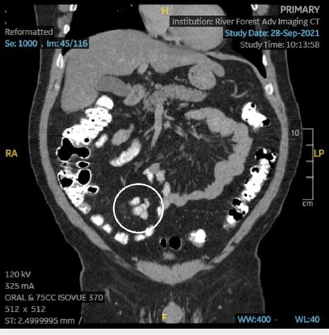 Ct Coronal Image Showing Enlargement Of The Appendix And Adjacent Ct Coronal Image Showing Enlargement Of The Appendix And Adjacent