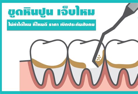 ขูดหินปูน เจ็บไหม ไม่ทำได้ไหม ที่ไหนดี ราคา เบิกประกันสังคม