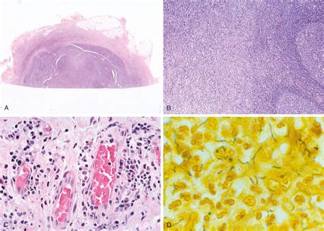 Reactive Lymphadenopathies Clinical Tree