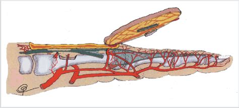 Composite Reverse Dorsal Metacarpal Artery Flap 8 Download Scientific Diagram
