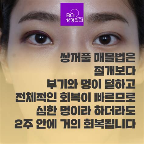 쌍꺼풀 매몰법 수술 후 시간에 따른 붓기 변화 중년눈성형 잘하는 비씨아이 눈매교정 눈성형의 모든것 비씨아이 성형외과