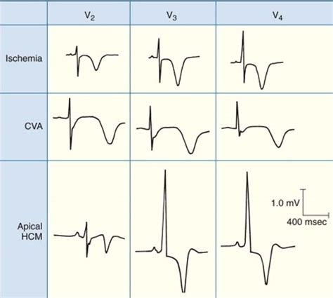 ECG T Wave Changes And Interpretation
