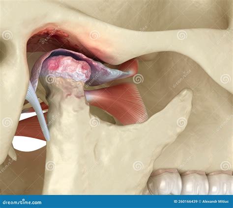 Tmj The Temporomandibular Joints Healthy Occlusion Anatomy Medically