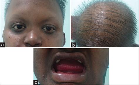 A Rare Case Of X Linked Hypohidrotic Ectodermal Dysplasia With Chorioretinal Lesions By Missense