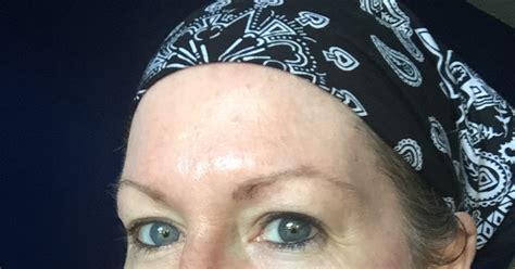 My Journey Through Topical Chemotherapy Fluorouracil 5 Cream And