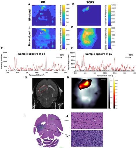 Non Invasive In Vivo Imaging Of Cancer Using Surface Enhanced Spatially