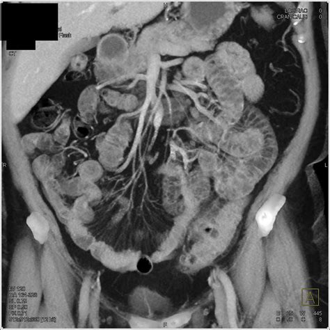 Diverticulitis In Sigmoid Colon Design Talk