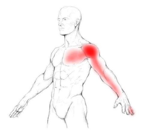 Pectoralis Minor Pain Trigger Points